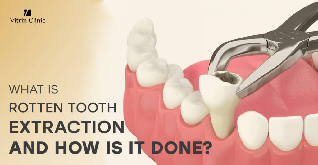 Rotten Tooth Extraction: 5 Powerful Facts You Must Know – Is It Really ...