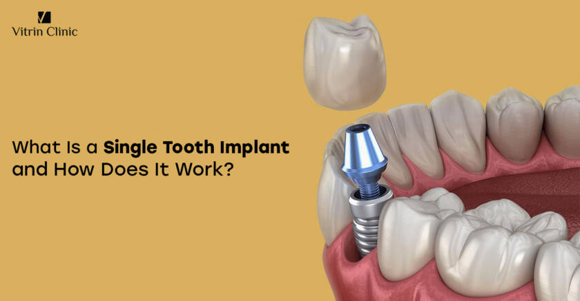 Is a Single Tooth Implant the 1 Life-Changing Solution for Missing ...