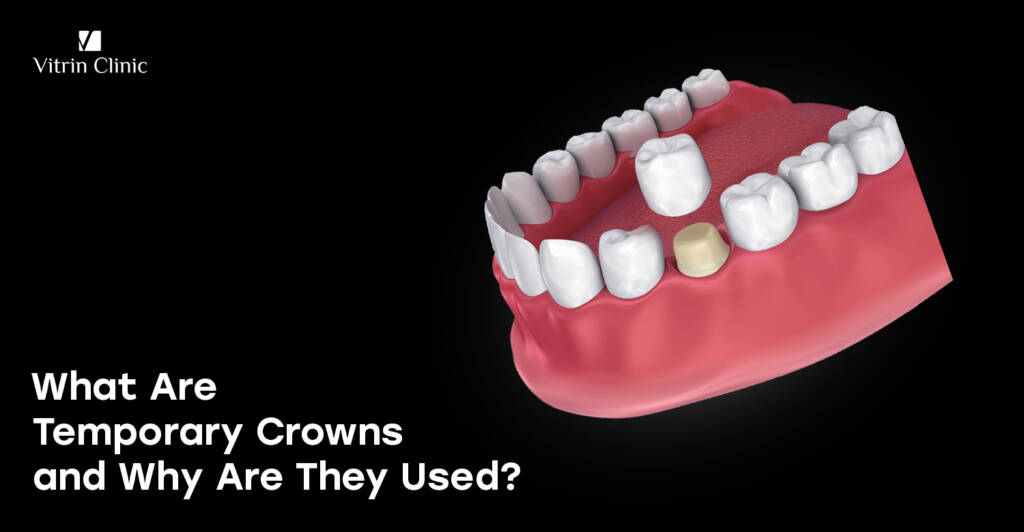 Why Temporary Crowns Are an Essential Solution in 2025? - Vitrin Clinic