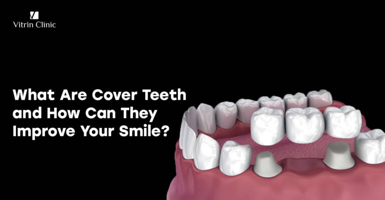 What Are Cover Teeth and How Can They Improve Your Smile? - Vitrin Clinic