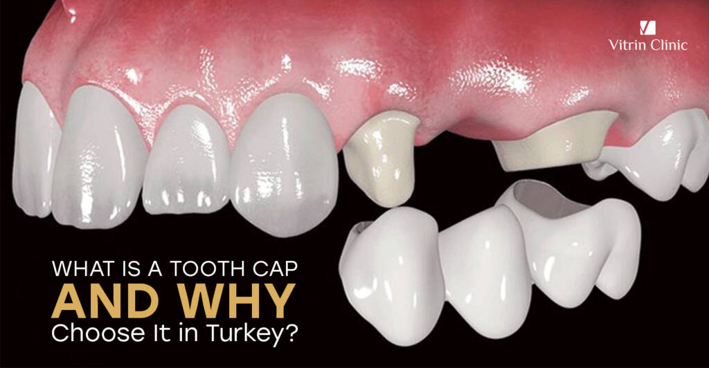 What Is Tooth Cap and Why Choose It in Turkey? - Vitrin Clinic
