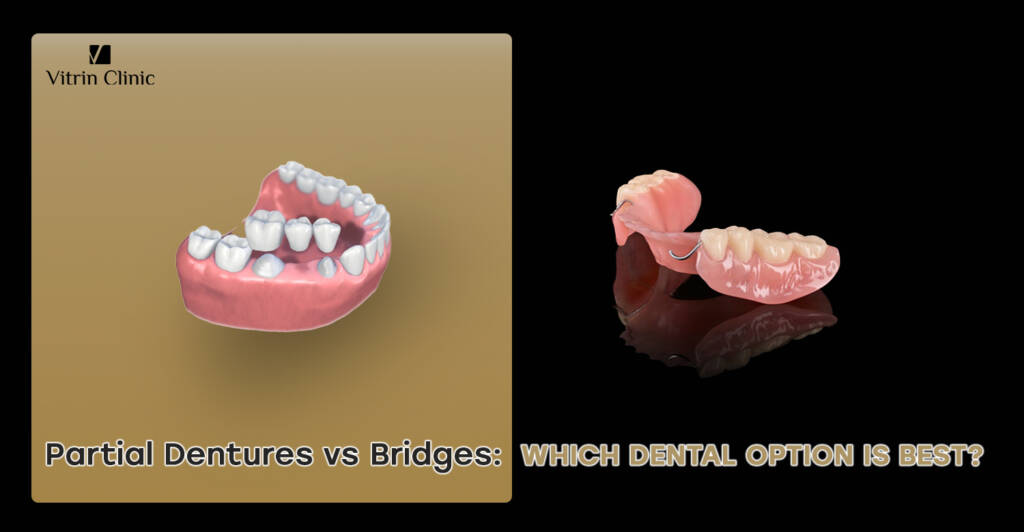 Partial Dentures vs Bridges: 5 Key Reasons to Choose Wisely? - Vitrin ...