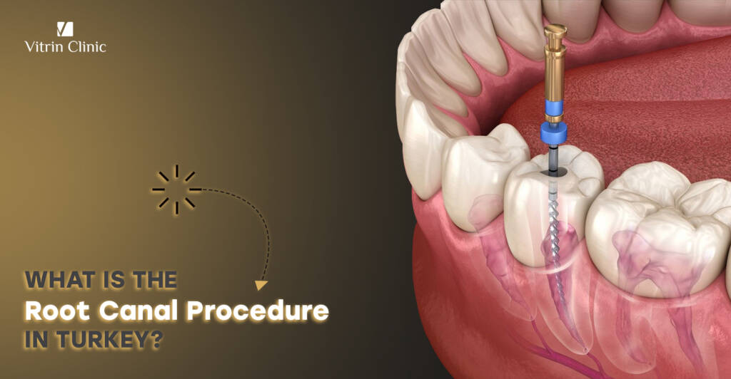What Is the Root Canal Procedure in Turkey? - Vitrin Clinic
