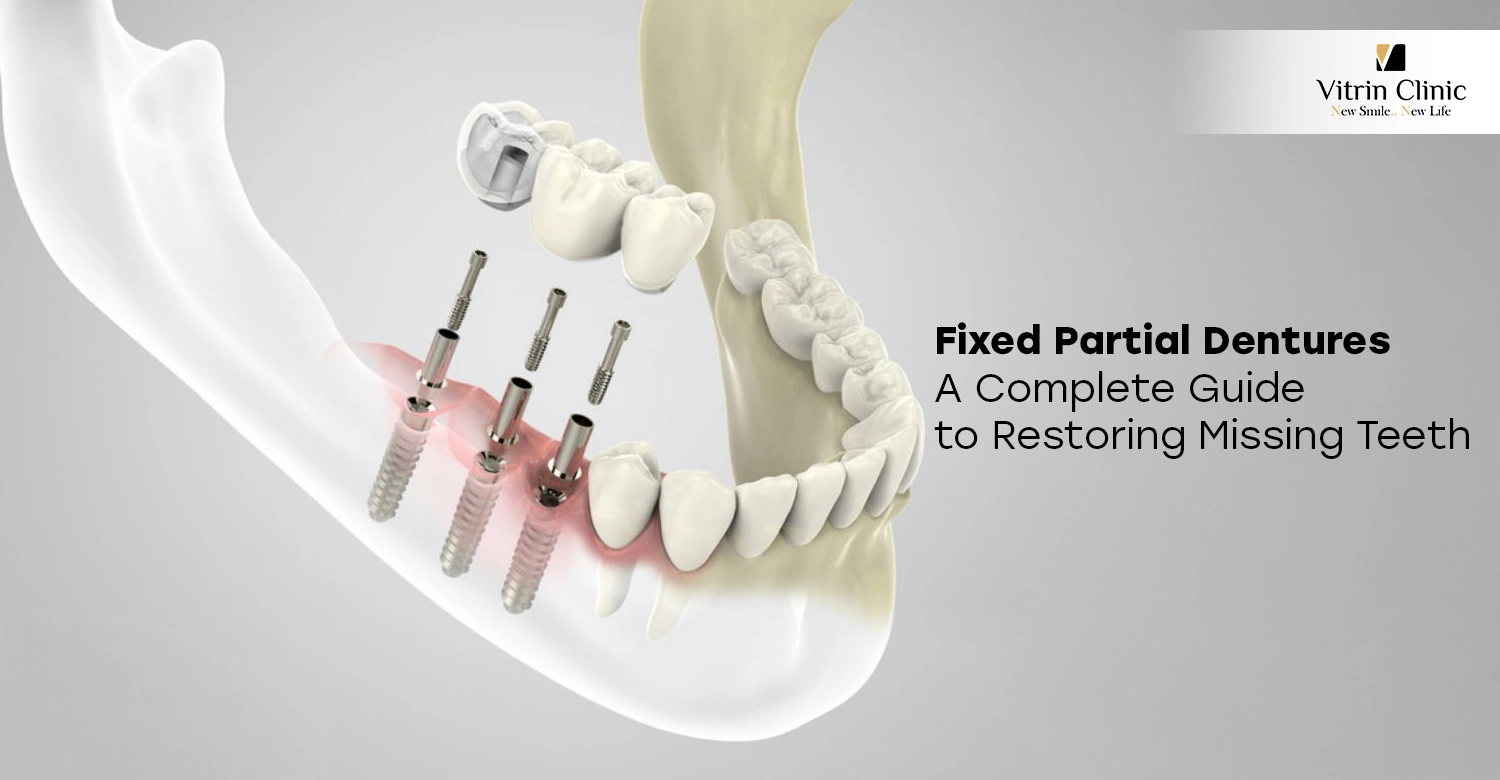 Fixed Partial Dentures: Bridge Solutions & Cost | VitrinClinic