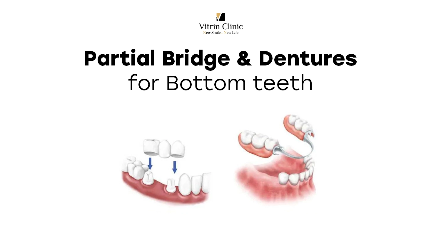 bridge lower partial dentures bottom front teeth | Vitrin